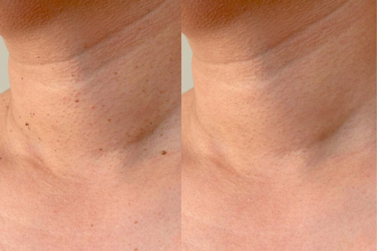 Expert Skin Tag Removal San Francisco | We Remove Skin Tags